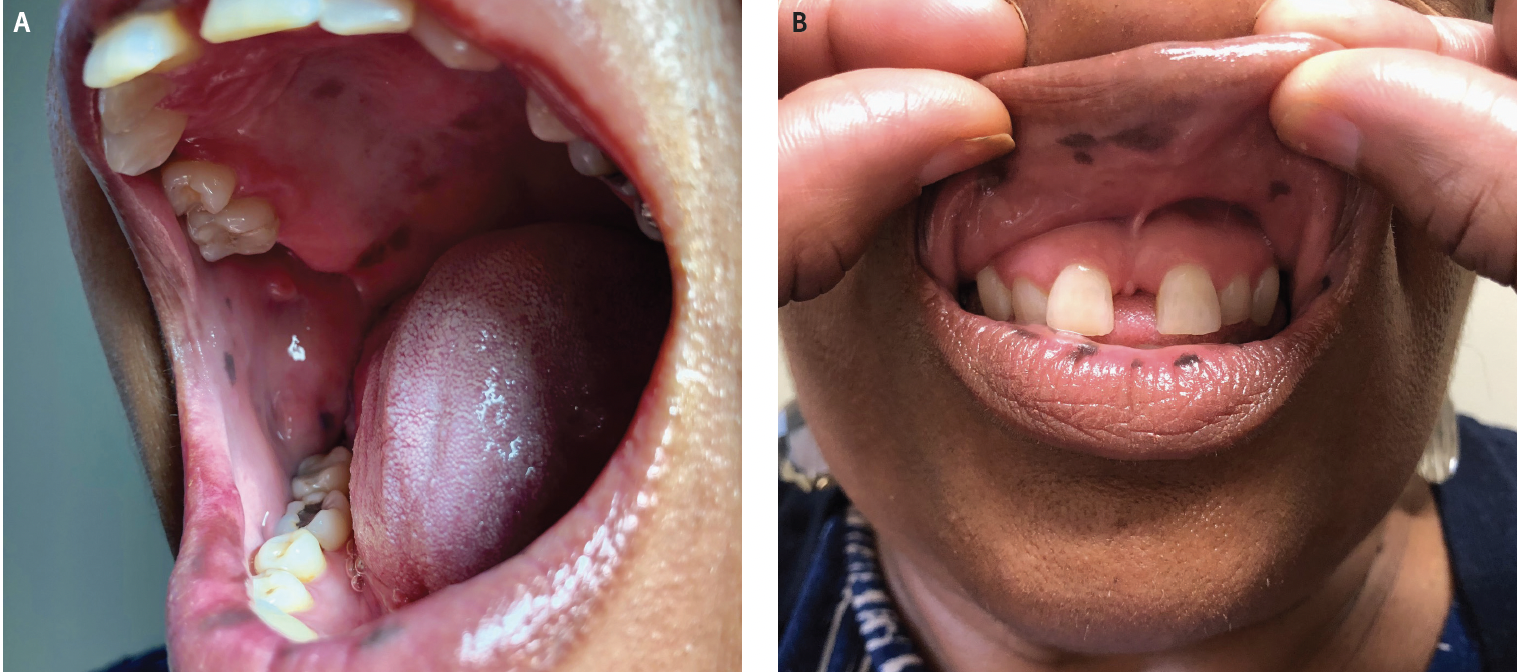 What Caused These Multiple Hyperpigmented Macules Of The Mouth